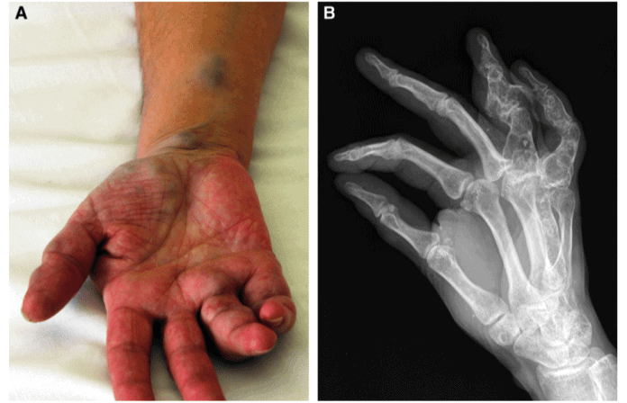 Maffuccijev sindrom - Portal o fizikalnoj terapiji - Fizioterapeut HR