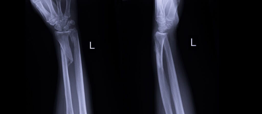 Prijelom "loco typico" - Portal o fizikalnoj terapiji